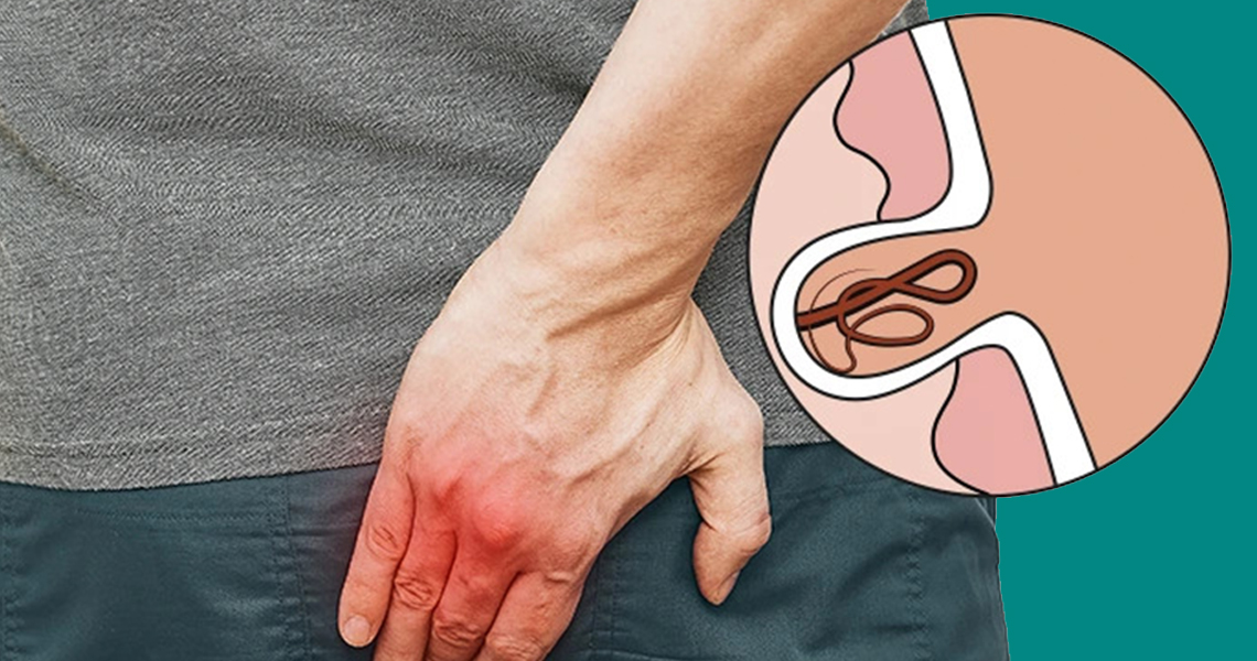 How to Treat Pilonidal Sinus: A Complete Guide for Treatment | Colon ...